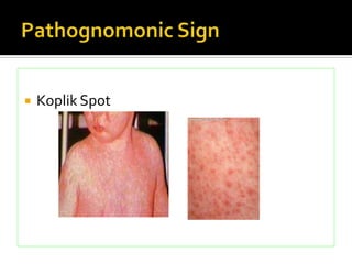 Measles | PPT