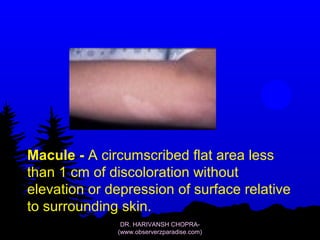 Measles dr harivansh chopra | PPT