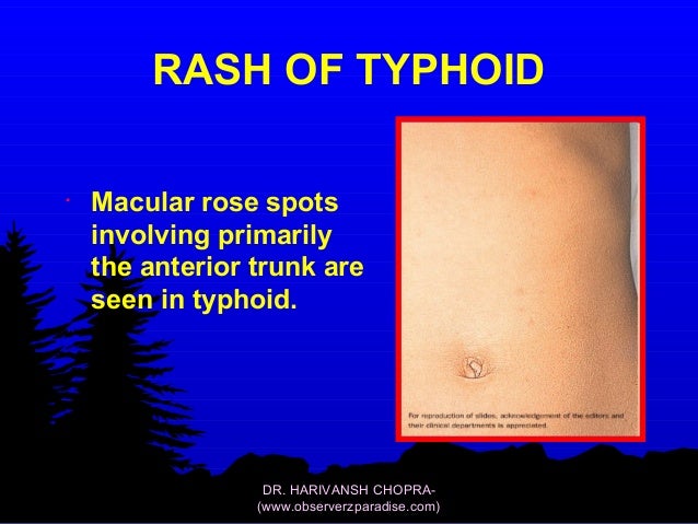 Salmonella Typhi Rose Spots