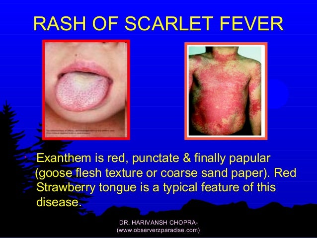 Measles dr harivansh chopra
