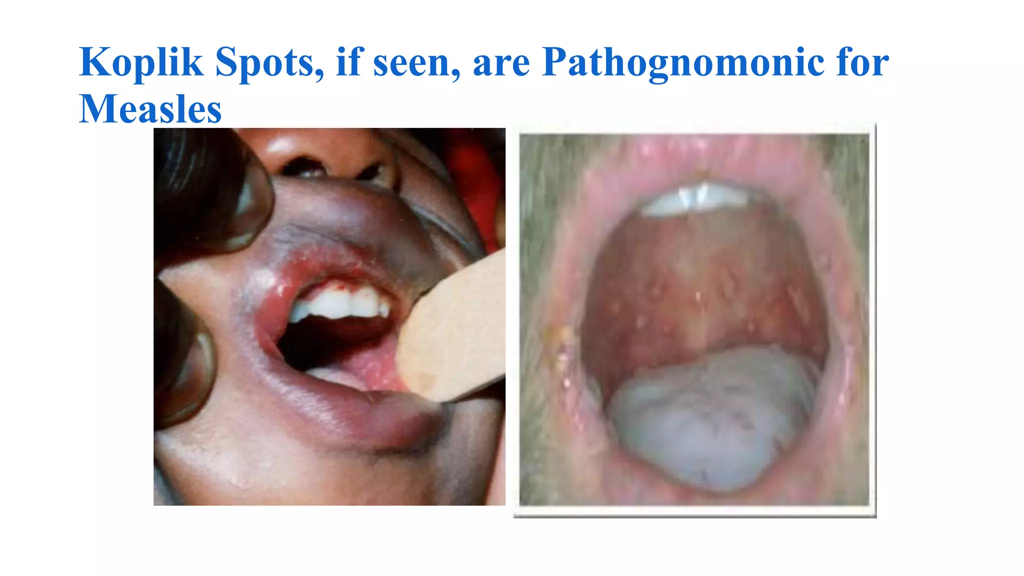 Measles and rubella | PPTX