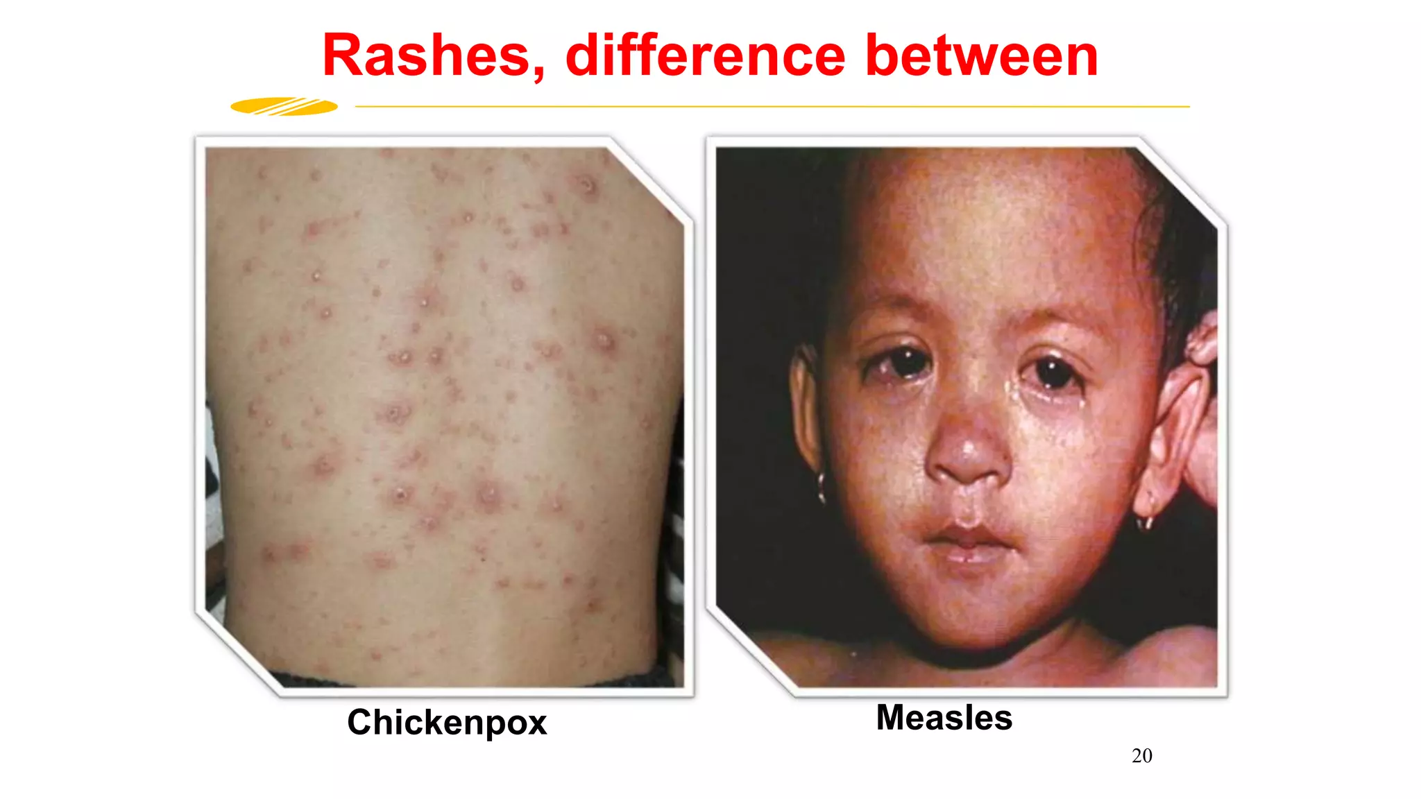 Measles and rubella | PPTX