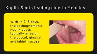 Measles by rehana majeed (1) | PPTX