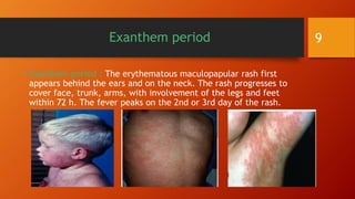 Measles in Pediatrics.pptx