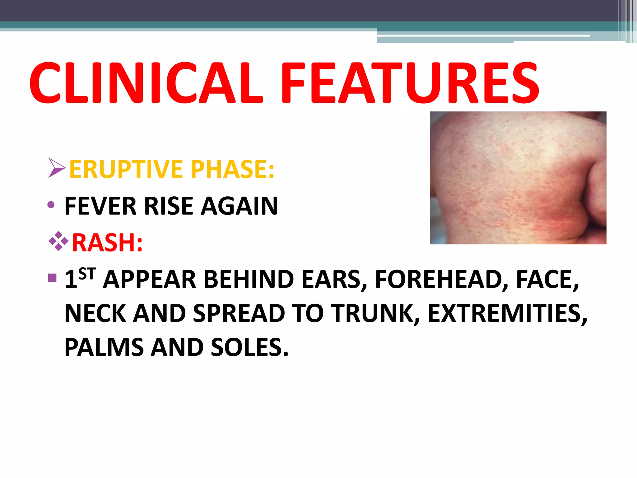 Measles mumps rubella ayurvedic and modern aspect | PDF