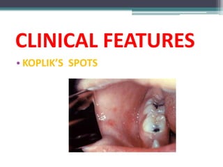 Measles mumps rubella ayurvedic and modern aspect | PDF