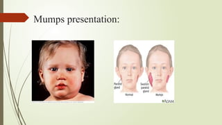 Measles Mumps Rubella.powerpoint presentation by Faith Muthoni, an IPC ...