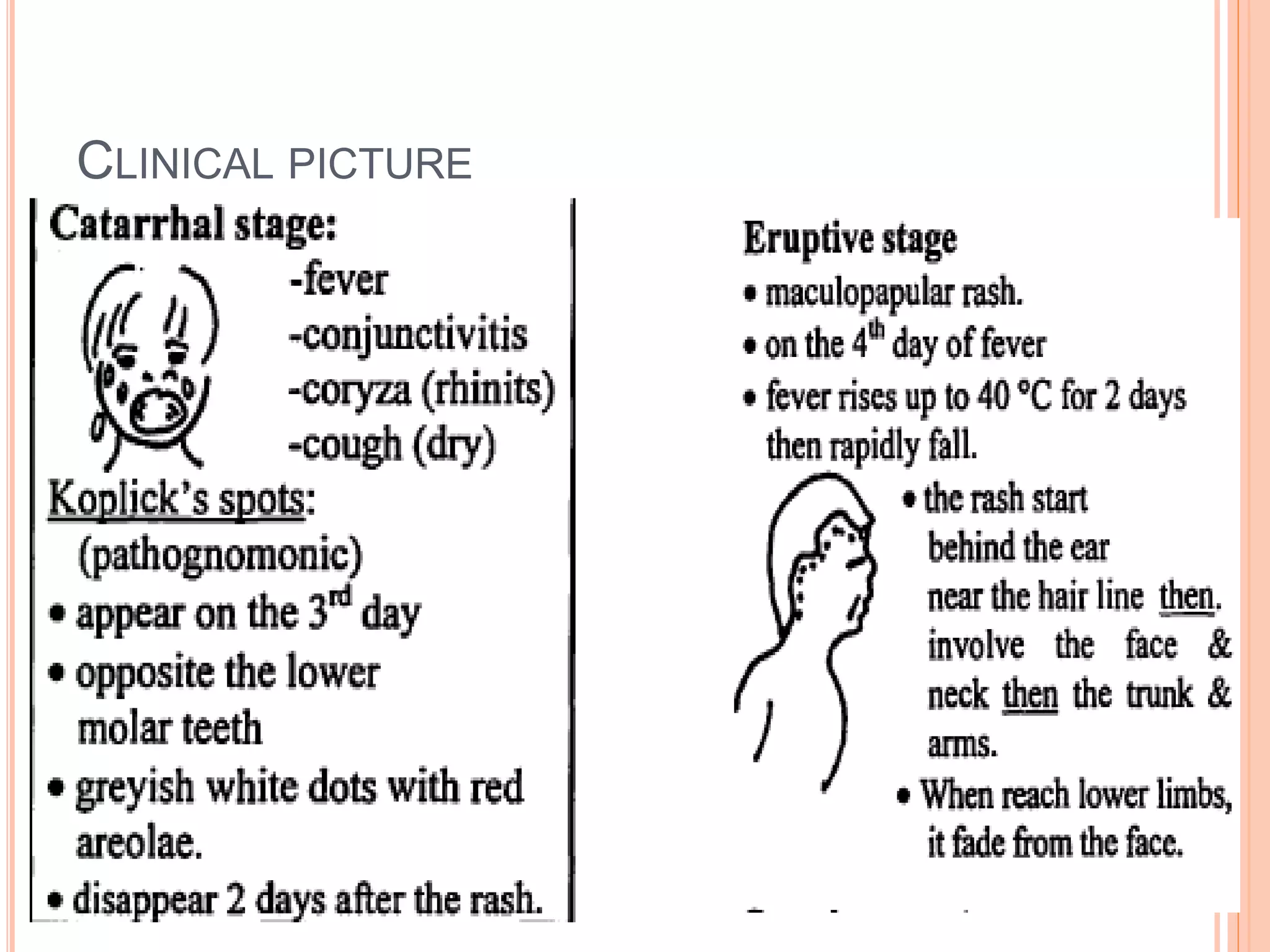 Management of measles. | PPTX