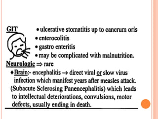 Management of measles. | PPTX