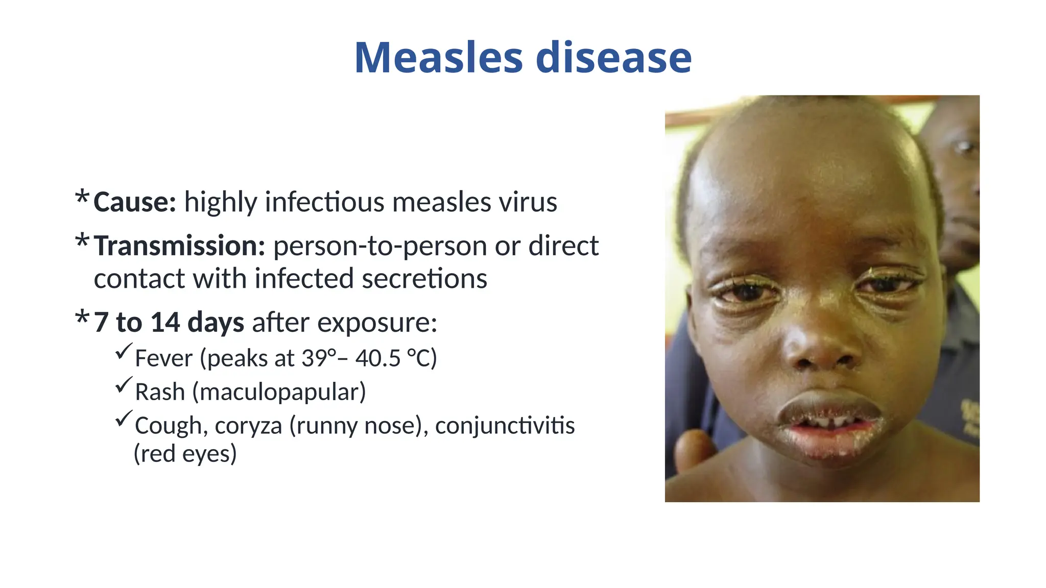 Measles outbreak and vaccination Universidade.pptx