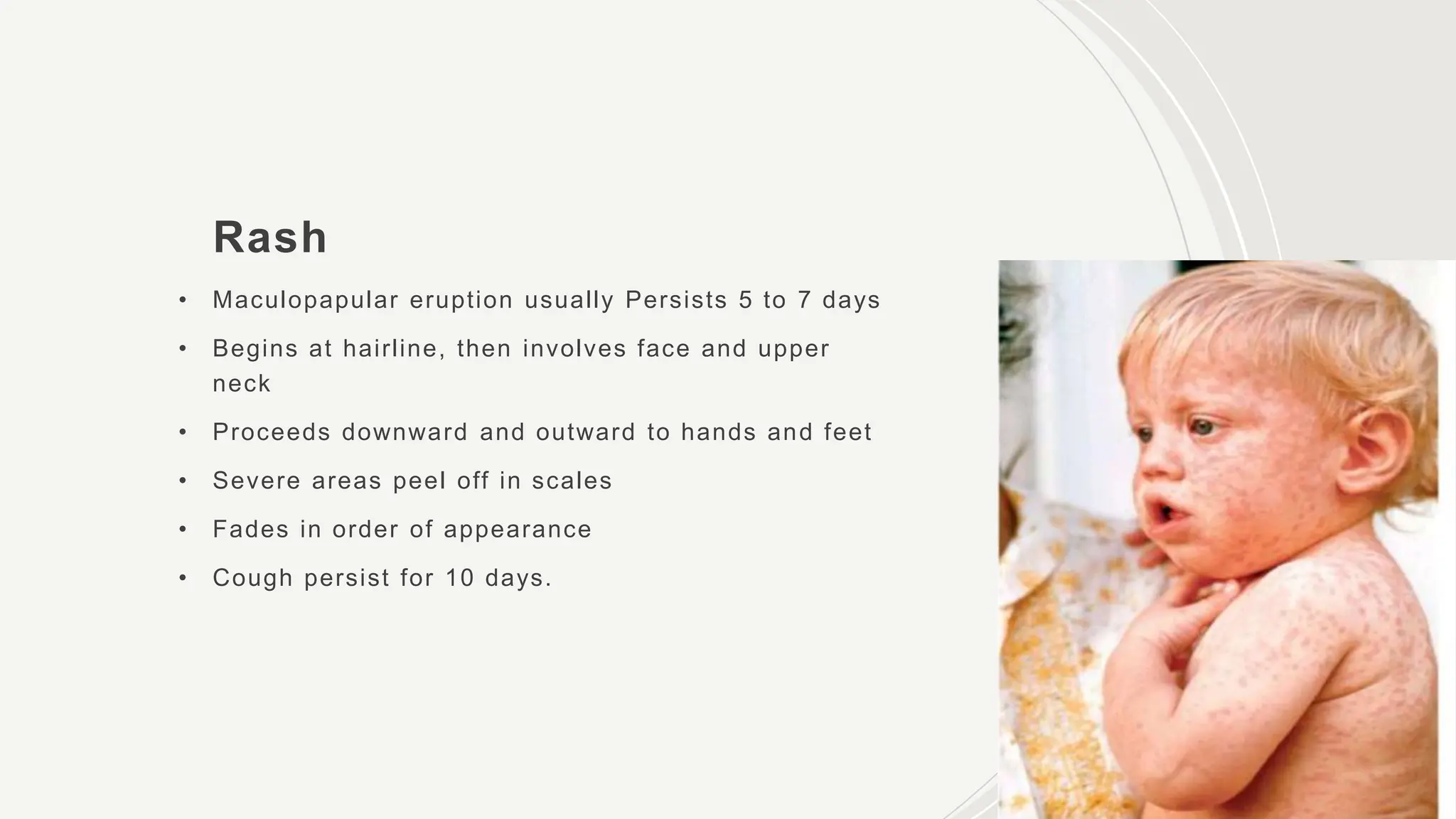 measles pathogenesis and prevention.pptx