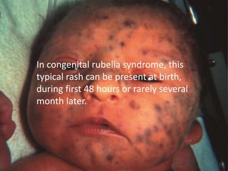 Congenital Rubella Syndrome Blueberry Muffin Rash