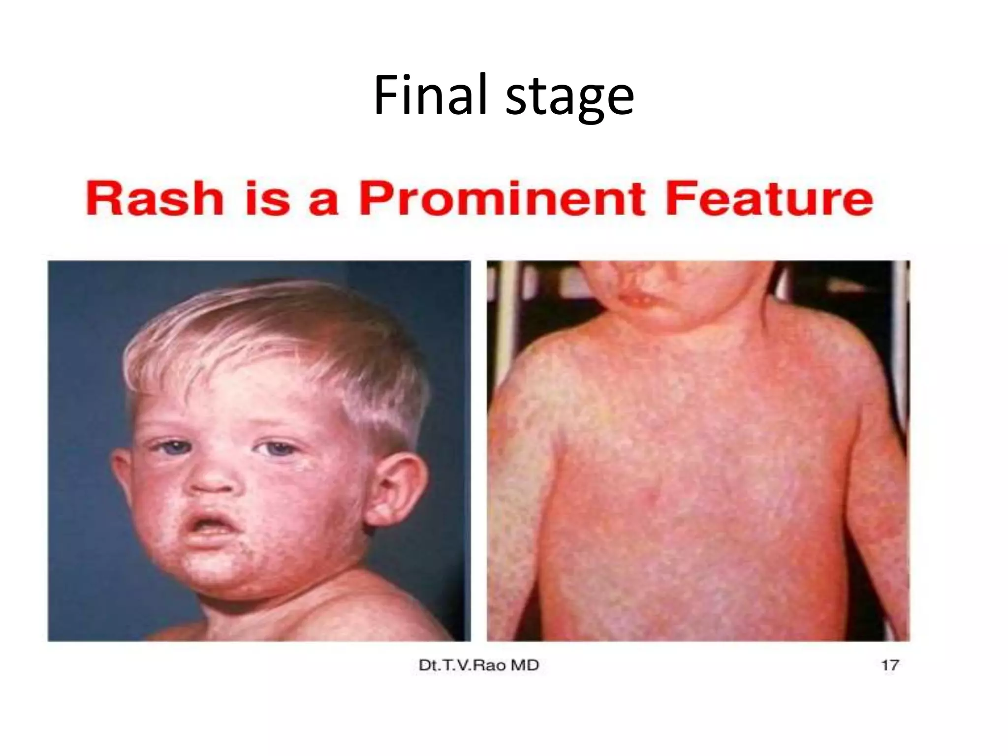 fever with rash in pediatric age groups | PPTX