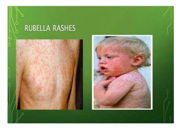 fever with rash in pediatric age groups | PPTX