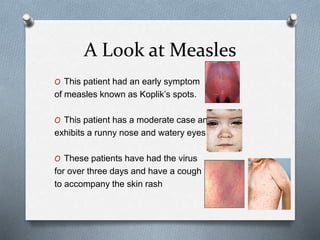 Measles (rubeola) | PPTX