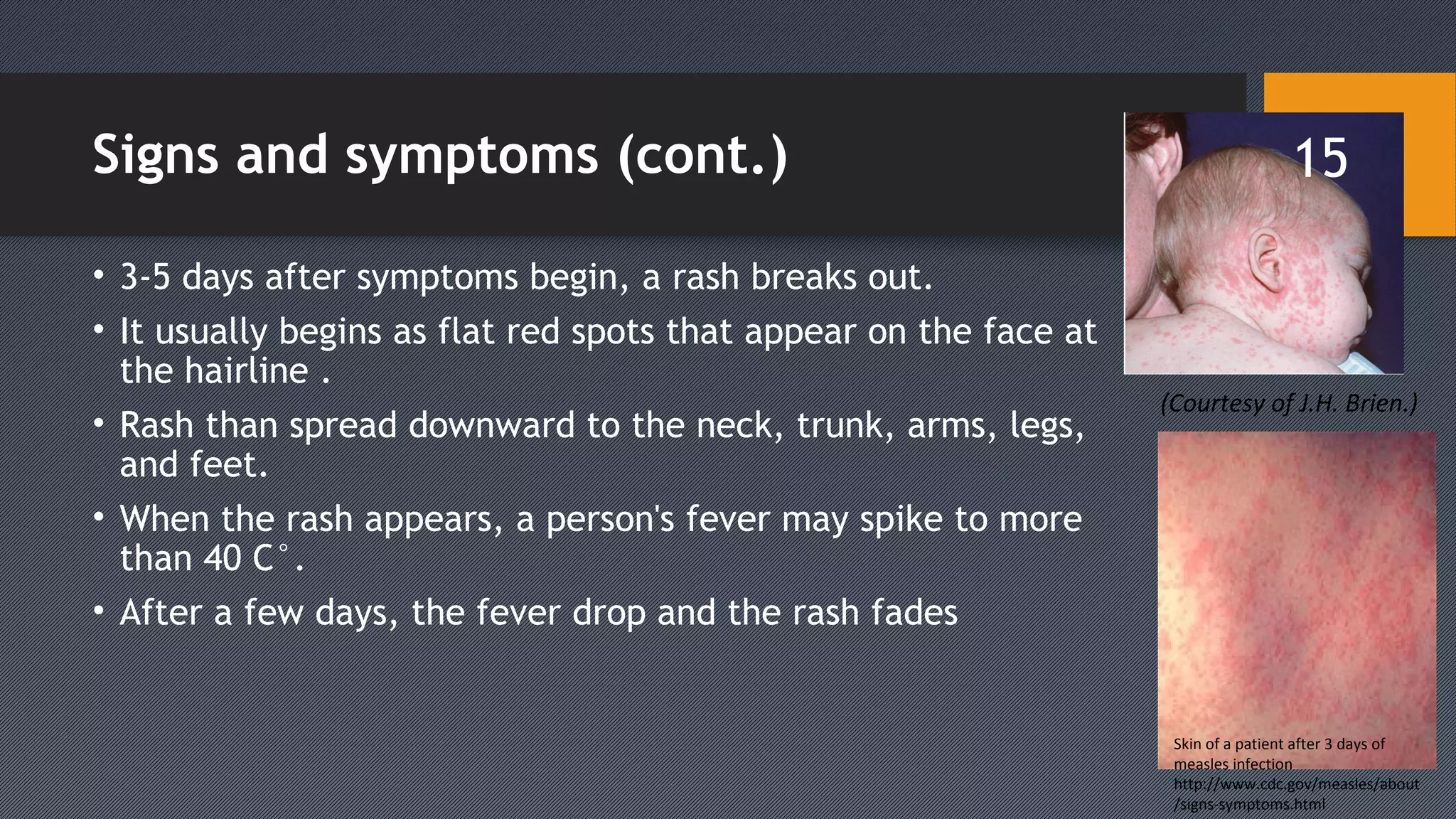 Measles | PPT