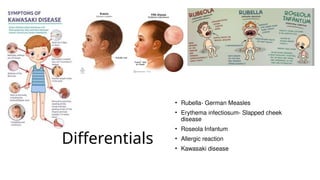 Measles presentation on infectious diseases in paediatric patients | PPTX