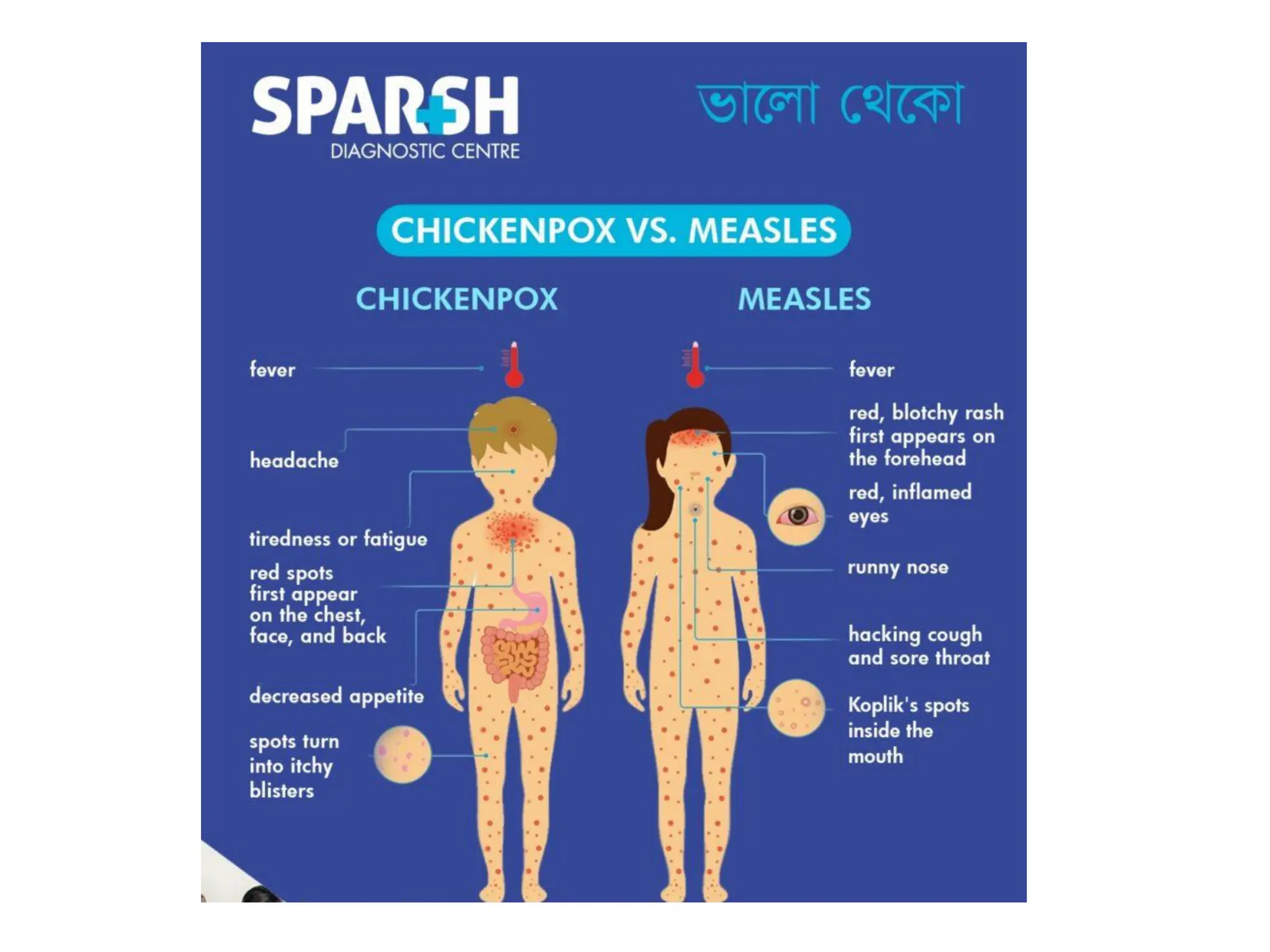 Measles Vs Chickenpox With Definition Causes Symptoms Stages