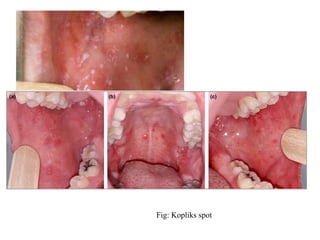 Measles vs chickenpox ms..pptx agent, host, environmental transmission ...