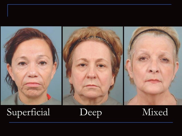 Measurement Of Facial Skin And Soft Tissue Laxity | PPT
