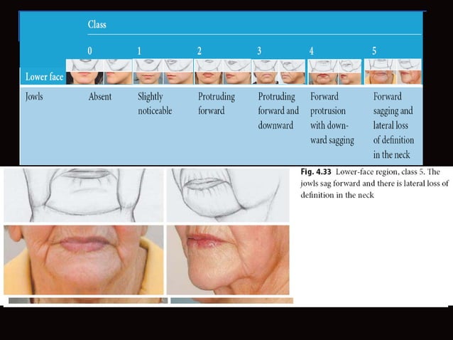 Measurement Of Facial Skin And Soft Tissue Laxity | PPT