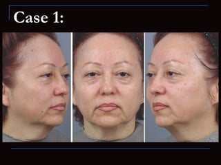 Measurement Of Facial Skin And Soft Tissue Laxity | PPT