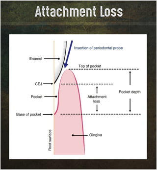 Measurement of Periodontal Attachment Loss | PDF