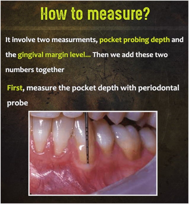 Measurement of Periodontal Attachment Loss | PDF