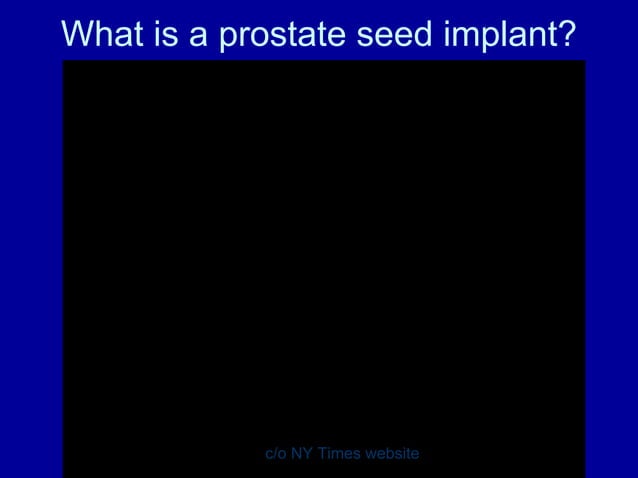 Measurement uncertainty and prostate seed brachytherapy gregory | PDF
