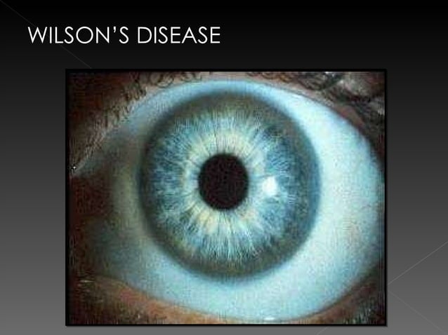 Common Genetic Diseases | PPT | Genetics | Science
