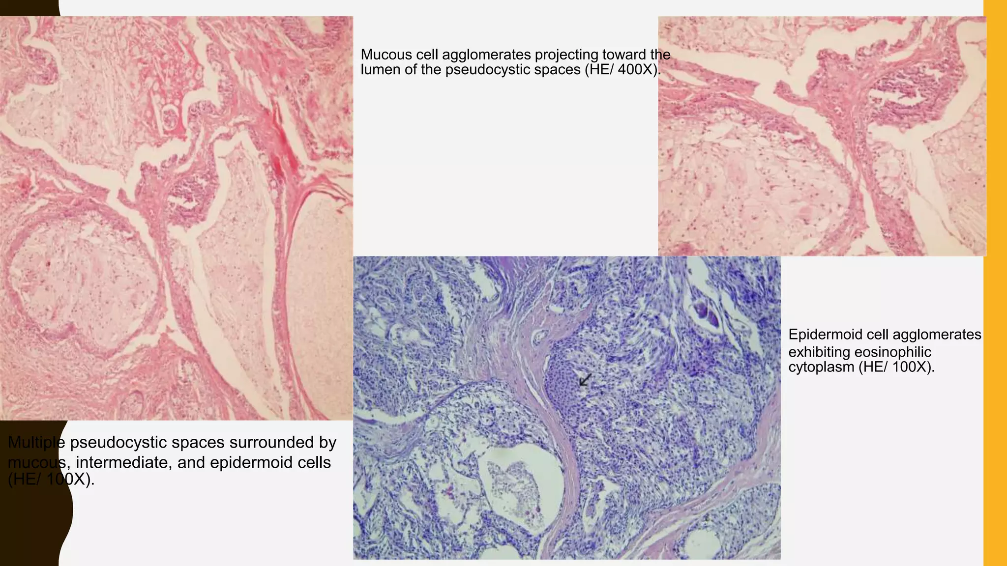 MUCOEPIDERMOID CARCINOMA | PPTX