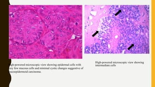 MUCOEPIDERMOID CARCINOMA | PPTX