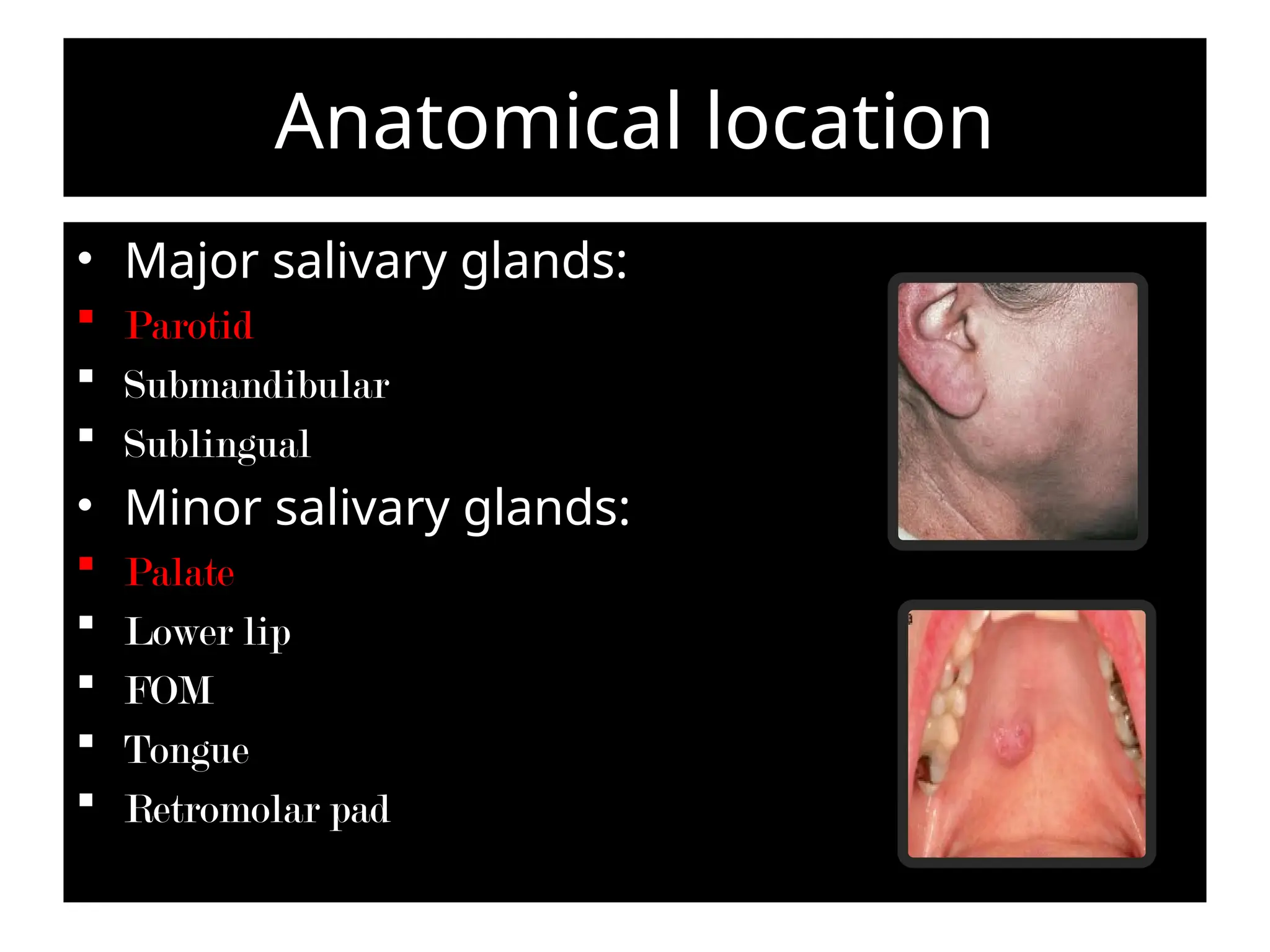 Mucoepidermoid carcinomas salivary gland | PPTX