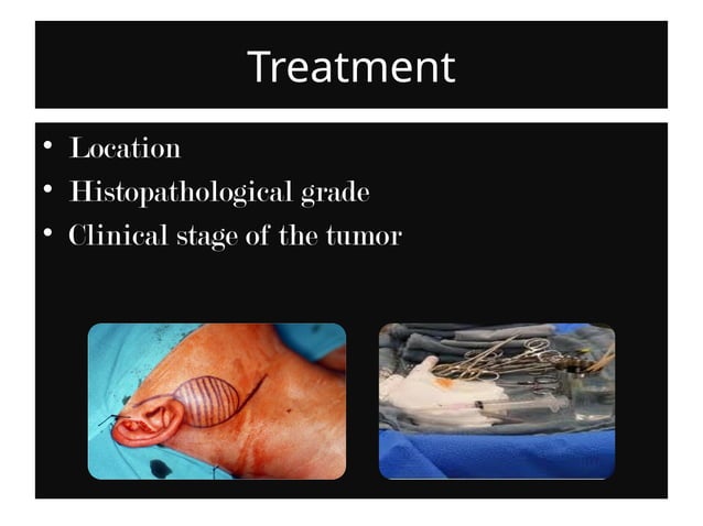 Mucoepidermoid carcinomas salivary gland | PPTX