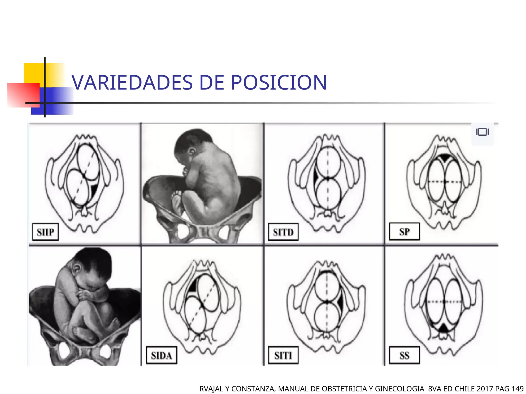 MECANISMO DEL PARTO PODALICO Y VARIEDADES JOSELYN ABAD.ppt