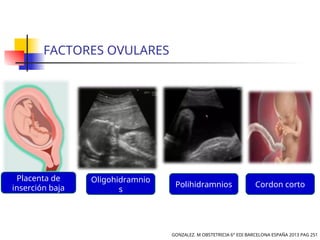 MECANISMO DEL PARTO PODALICO Y VARIEDADES JOSELYN ABAD.ppt