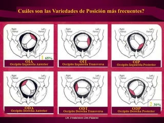 Mecanismo de parto cefalico normal en oiia 3 aaa | PPTX
