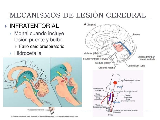 Mecanismos De Lesión Cerebral