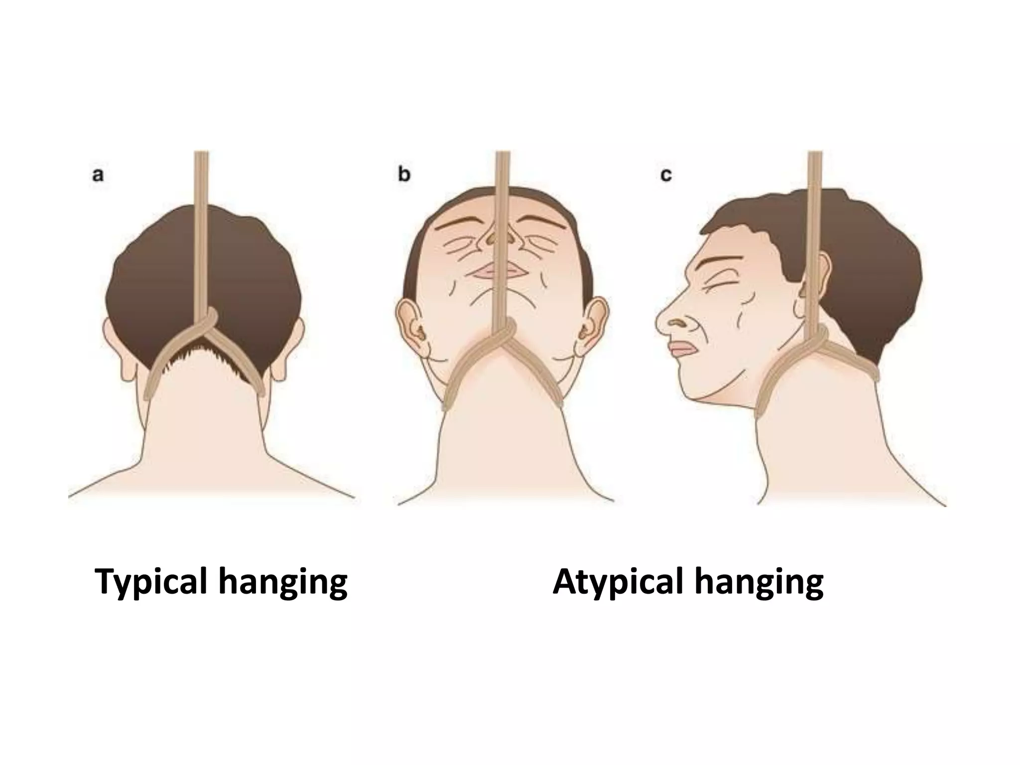 Mechanical asphyxia.pptx