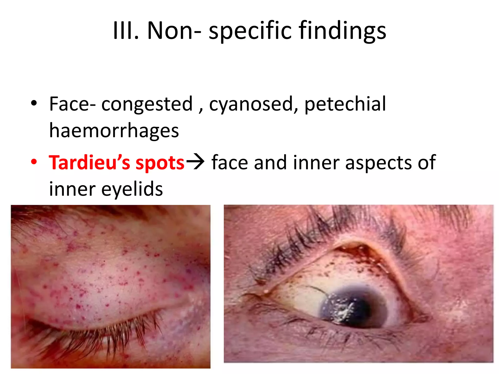Mechanical asphyxia.pptx