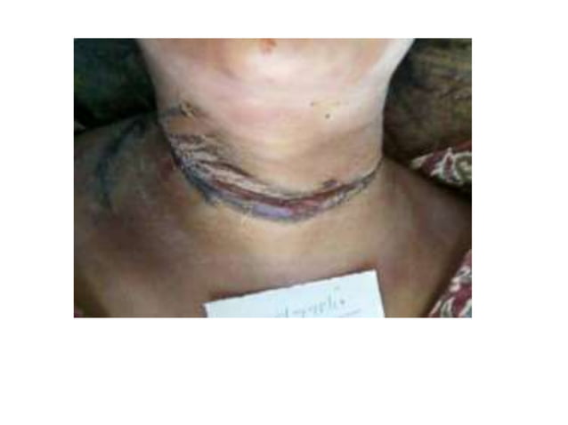 Mechanical asphyxia.pptx