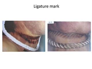 Mechanical asphyxia 1 | PPTX