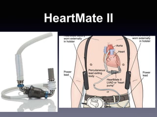 Mechanical circulatory support | PPT