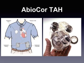 Mechanical circulatory support | PPTX