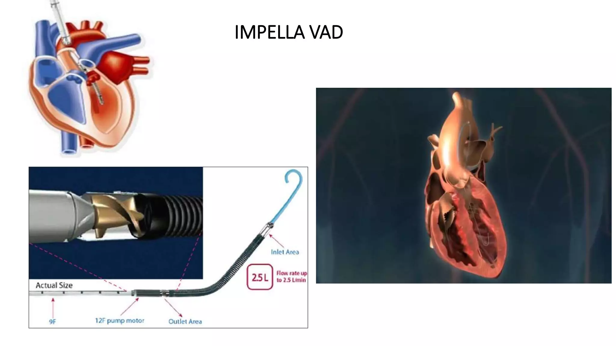Mechanical Circulatory Support.pptx