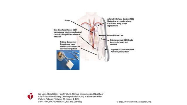 Mechanical Circulatory Support.pptx | Heart and Cardiovascular Diseases ...
