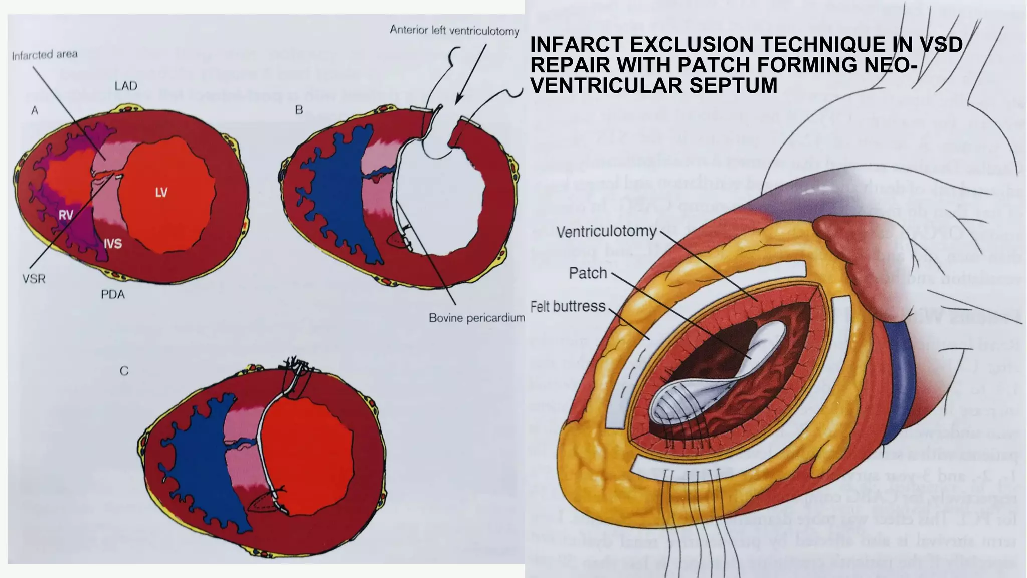 Mechanical complications of cad | PPTX