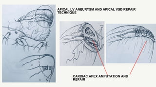 Mechanical complications of cad | PPT