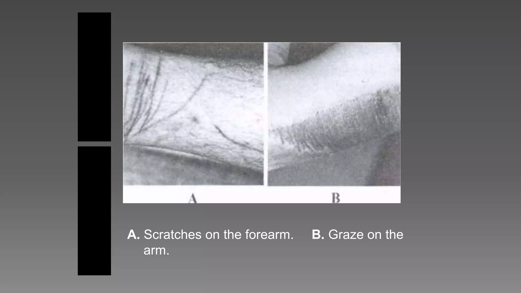 Mechanical injuries | PPTX