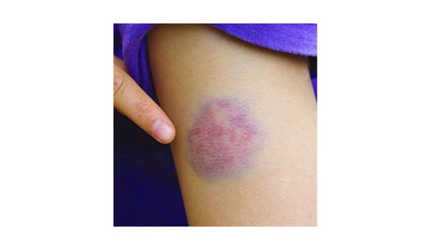 Mechanical injuries.pptx | First Aid | Injuries